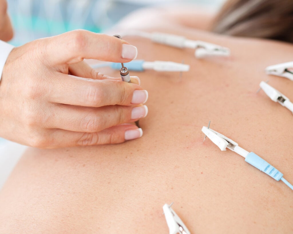 Electro Acupuncture in Flitwick, Bedfordshire